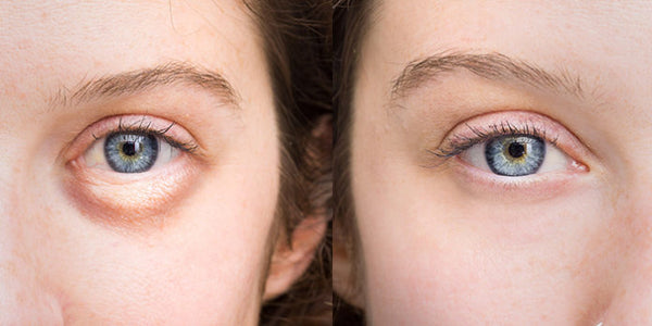 How to Get Rid of Puffy Eyes? | Get Rid Of Swollen Eyes