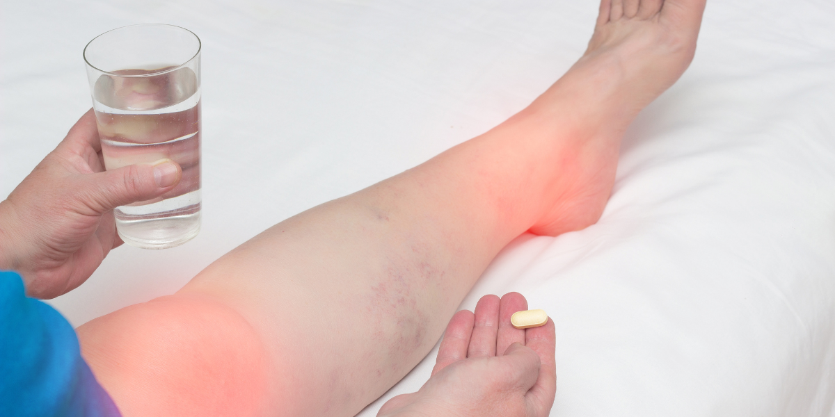 Understanding Edema and Swelling: Causes, Symptoms, and Treatment Opti